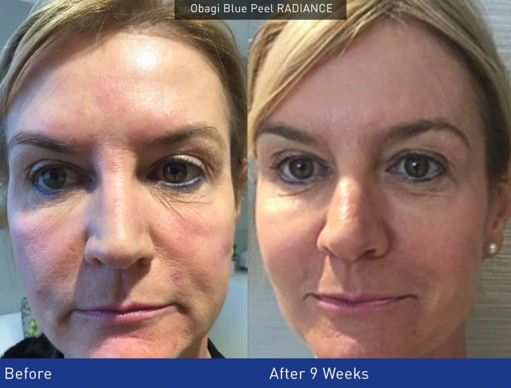 Chemical Peels Kent, Gravesend, Bromley | Obagi Medical Blue Peel Radiance