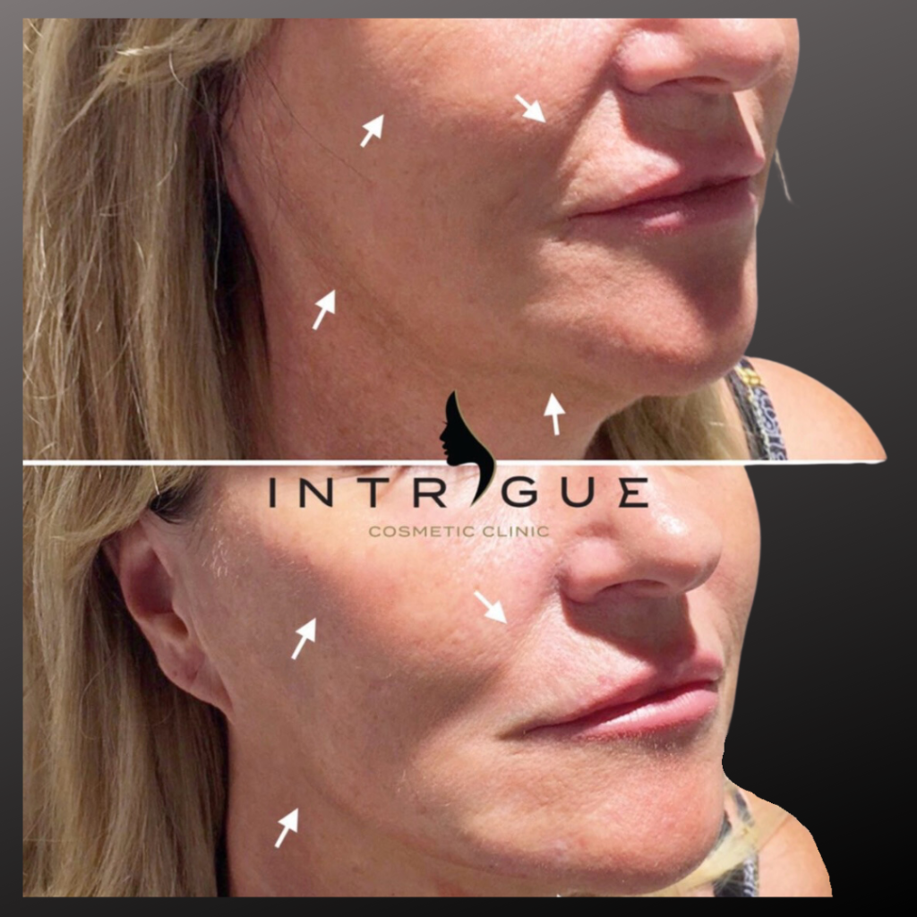 How To Get Rid Of Jowls With Fillers - Intrigue Clinic