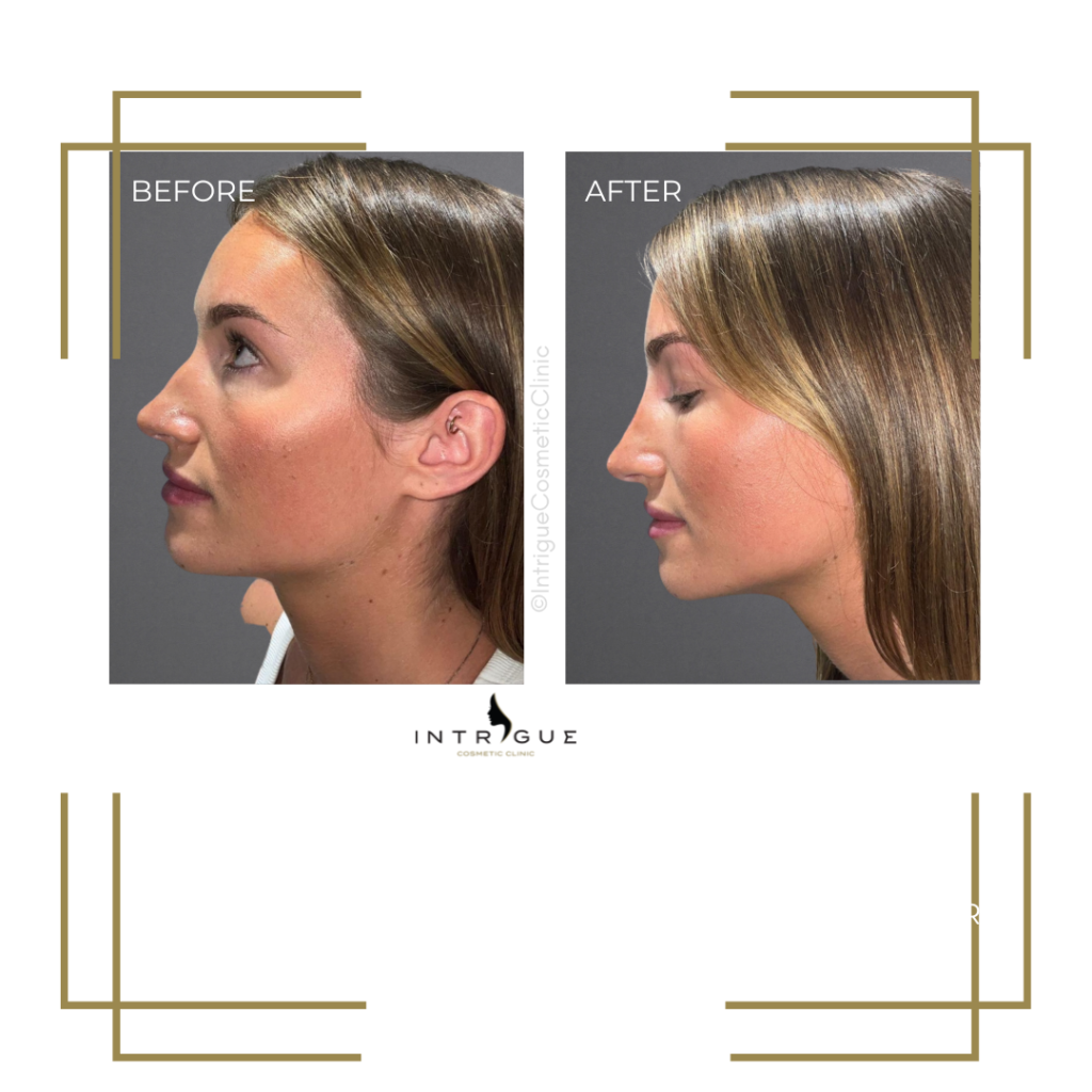 Dermal Filler Photos Before And After - Intrigue Clinic
